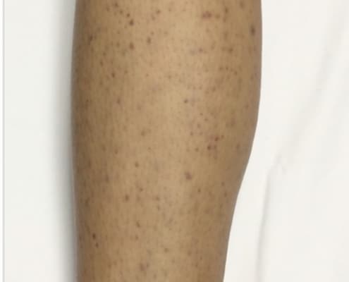 Before & After Images - Laser Hair Removal At Urban Body Laser