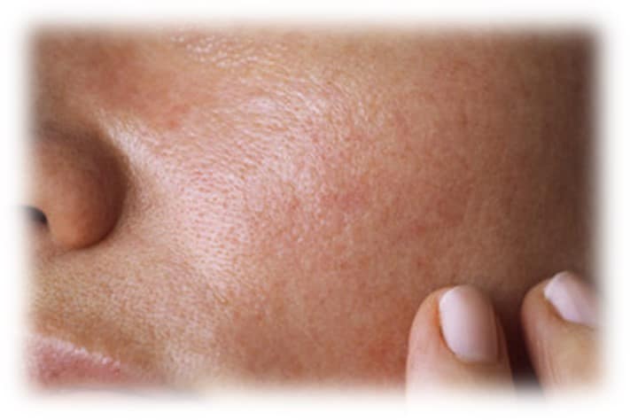 Understand Your Skin Type for Optimal Skincare | Urban Body Laser Vancouver